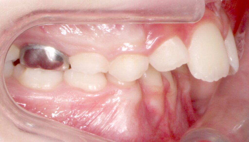 Common Orthodontic Problems San Antonio TX | Alamo Ranch Orthodontics