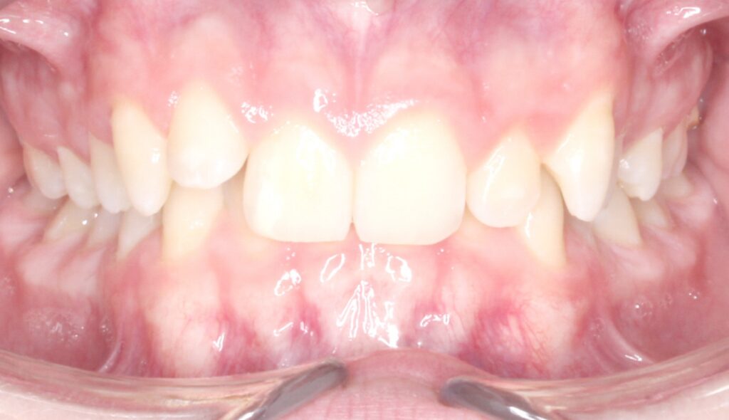 Common Orthodontic Problems San Antonio TX | Alamo Ranch Orthodontics