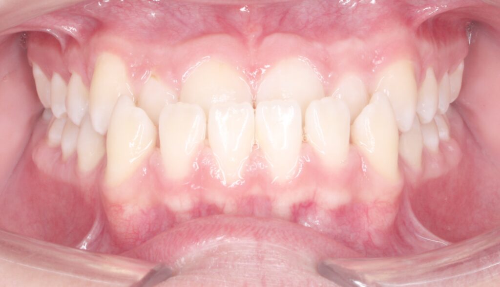 Common Orthodontic Problems San Antonio TX | Alamo Ranch Orthodontics
