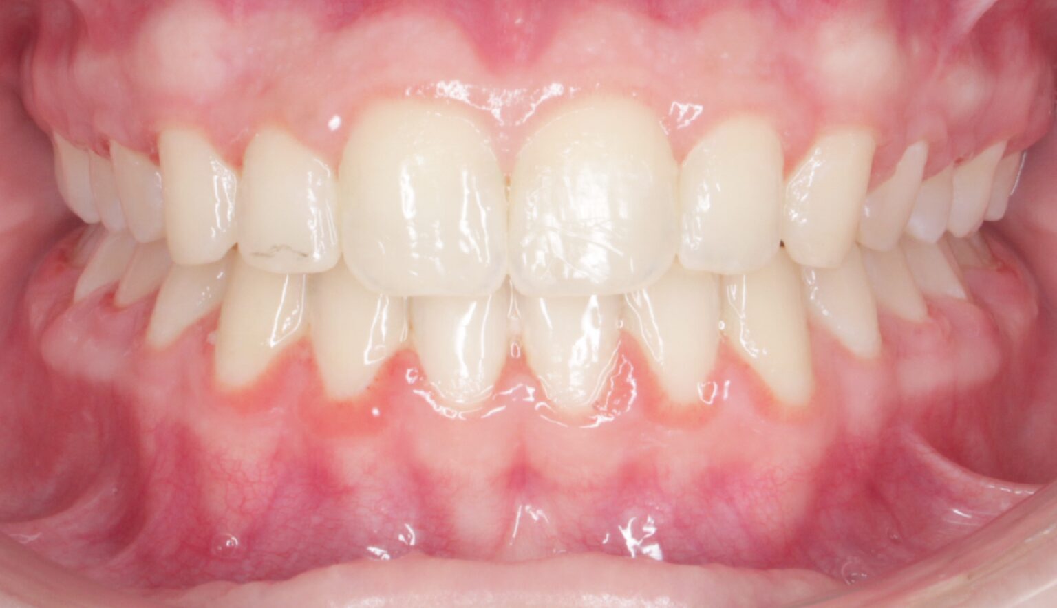 Before and after orthodontic treatment at Alamo Ranch Orthodontics