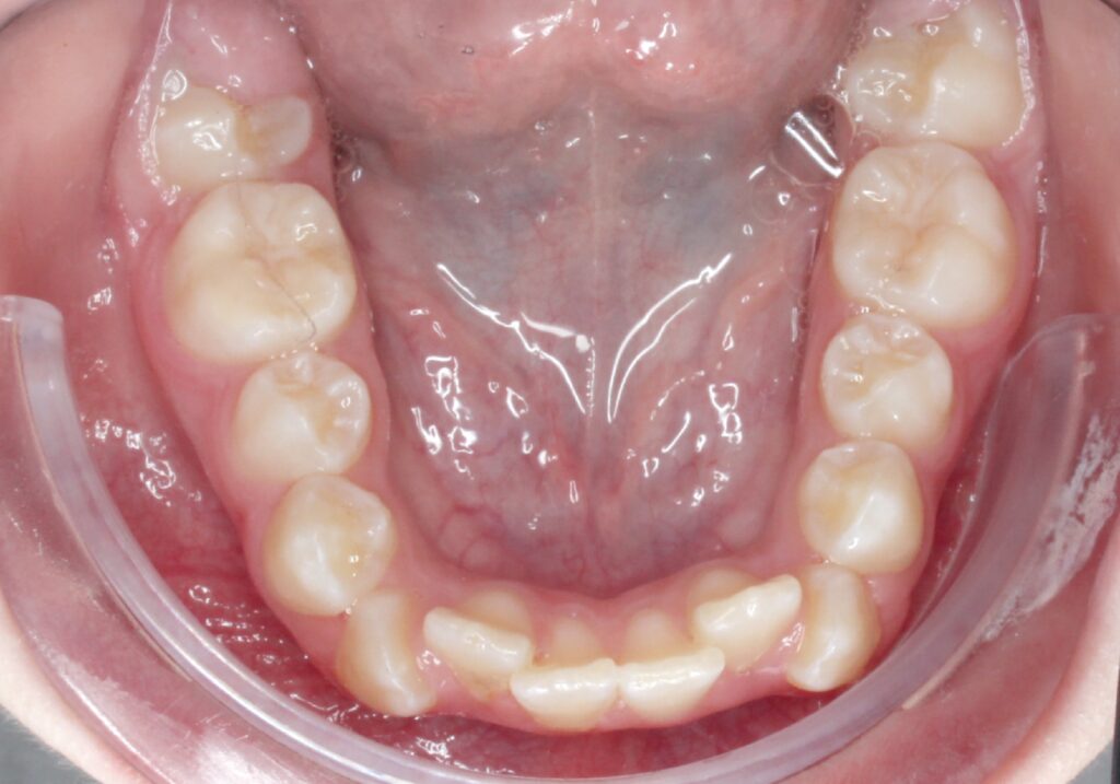 Common Orthodontic Problems San Antonio TX | Alamo Ranch Orthodontics