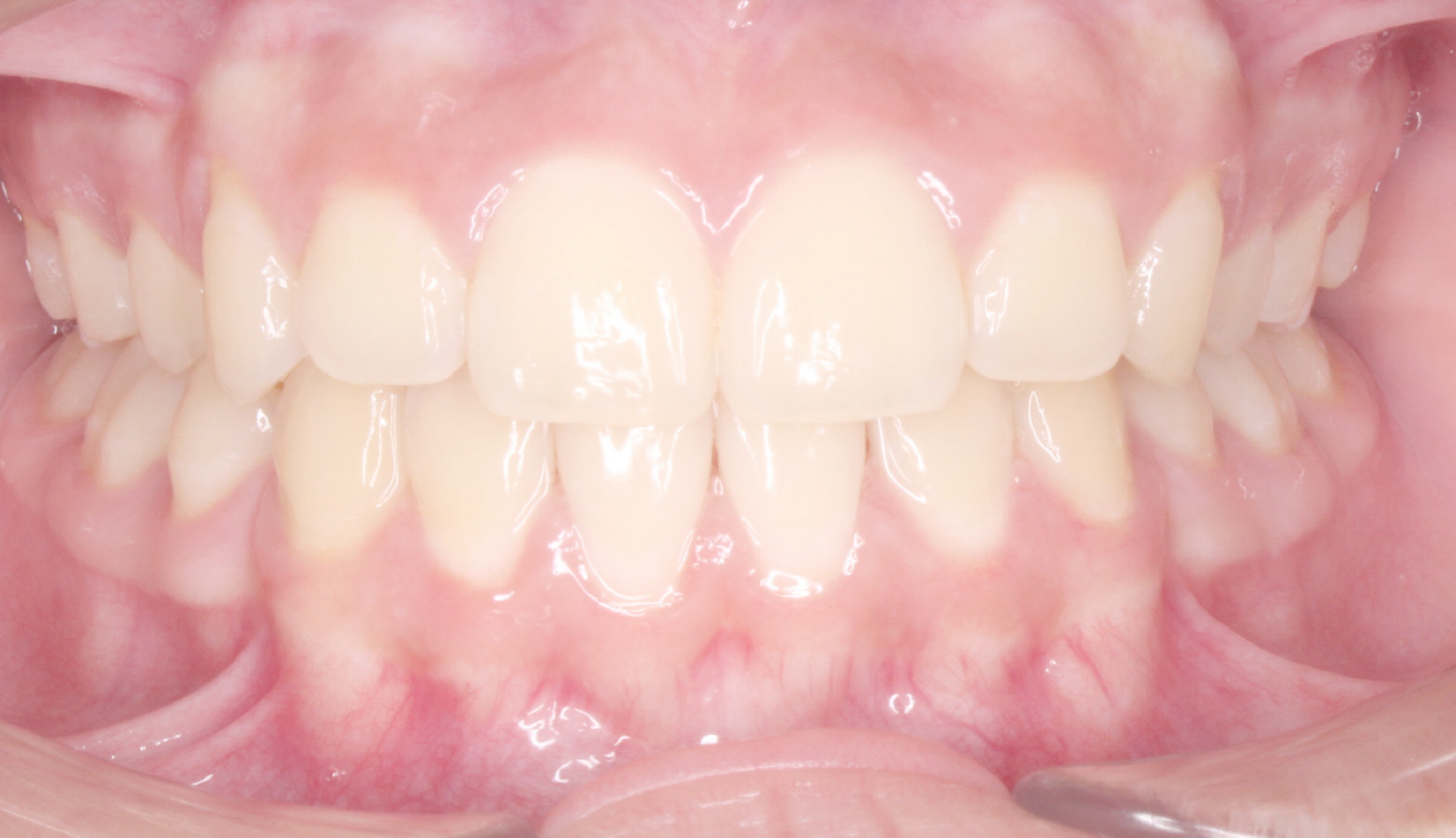 Before and after orthodontic treatment at Alamo Ranch Orthodontics